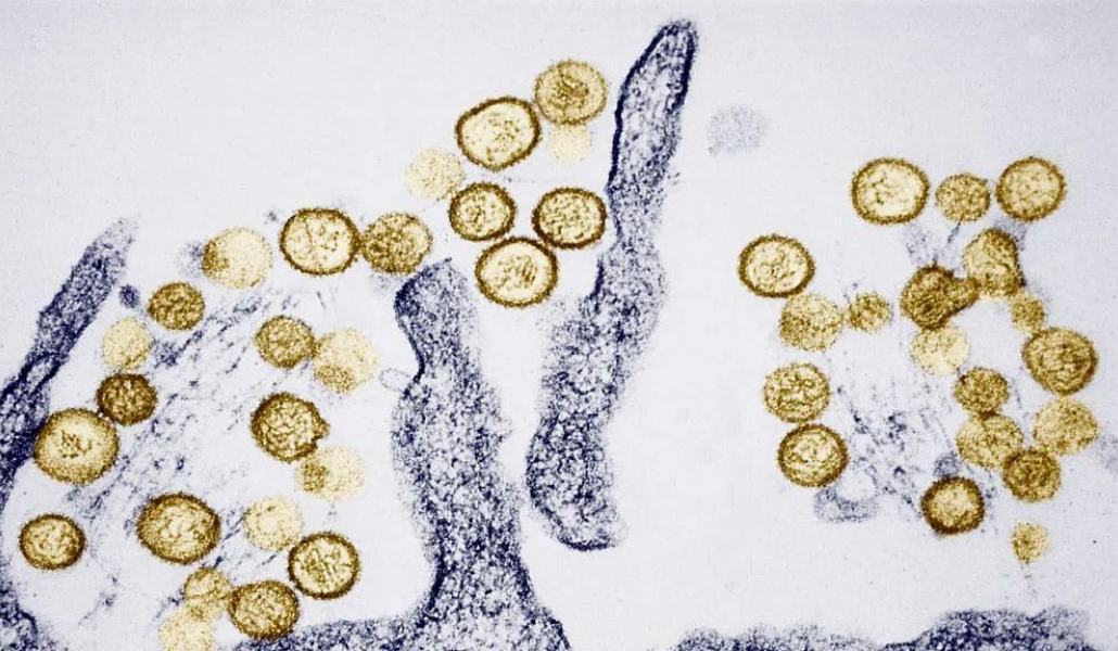 41 personas bajo vigilancia en EEUU por posible contagio de hantavirus ...